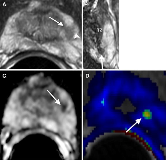 Benign causes of diffusion restriction foci in the peripheral zone of ...