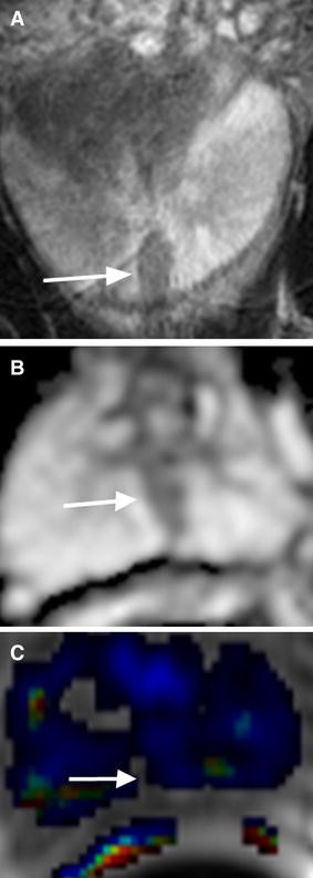 Benign causes of diffusion restriction foci in the peripheral zone of ...