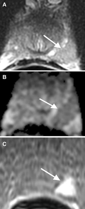 Benign causes of diffusion restriction foci in the peripheral zone of ...