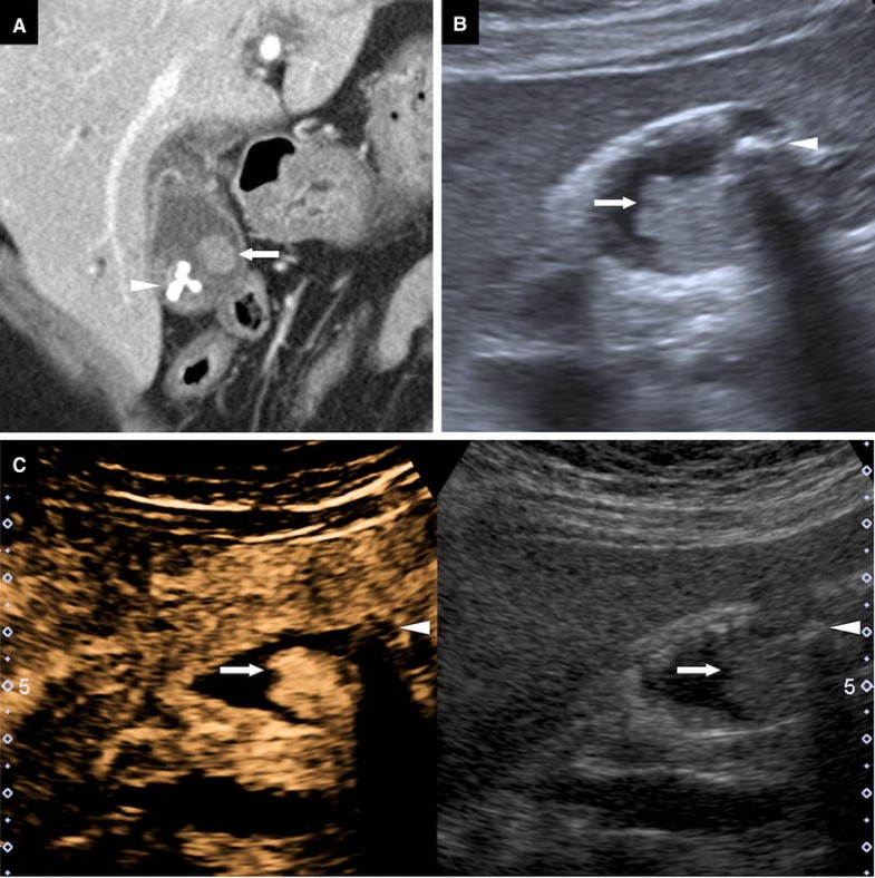 Contrast-enhanced ultrasound in gallbladder disease: a pictorial review ...