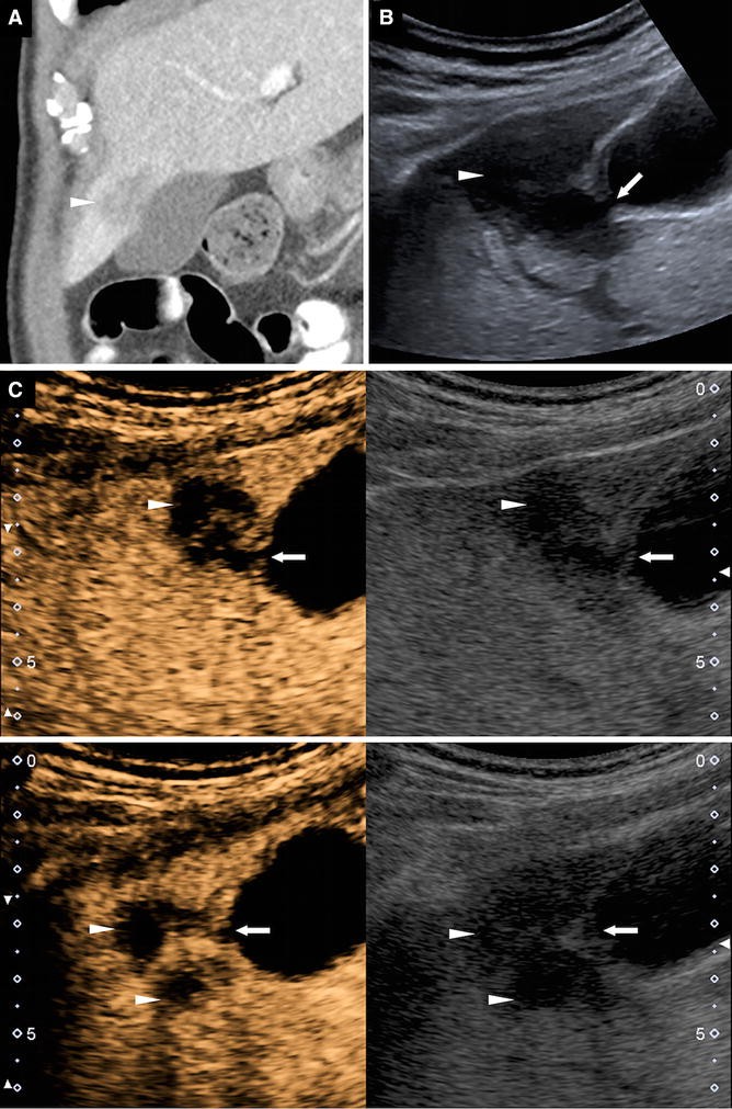Contrast-enhanced ultrasound in gallbladder disease: a pictorial review ...