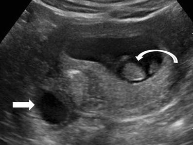 Radiological appearances of corpus luteum cysts and their imaging ...