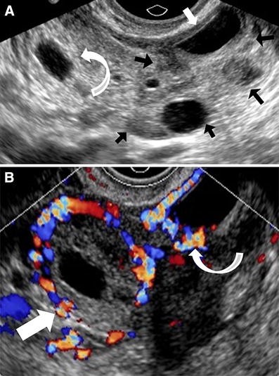 Radiological appearances of corpus luteum cysts and their imaging ...