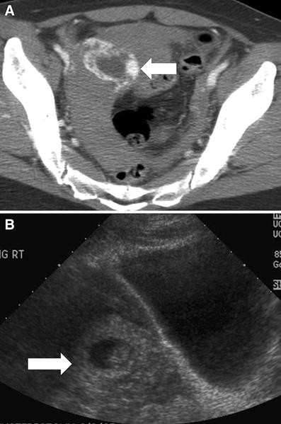 Radiological appearances of corpus luteum cysts and their imaging ...