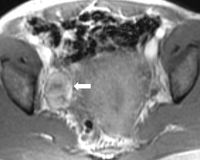 Radiological appearances of corpus luteum cysts and their imaging ...