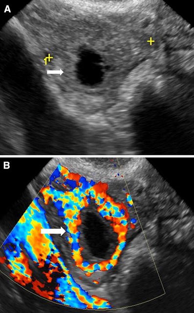 Radiological appearances of corpus luteum cysts and their imaging ...