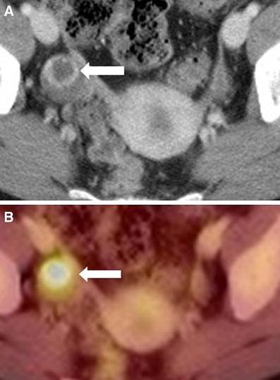 Radiological appearances of corpus luteum cysts and their imaging ...