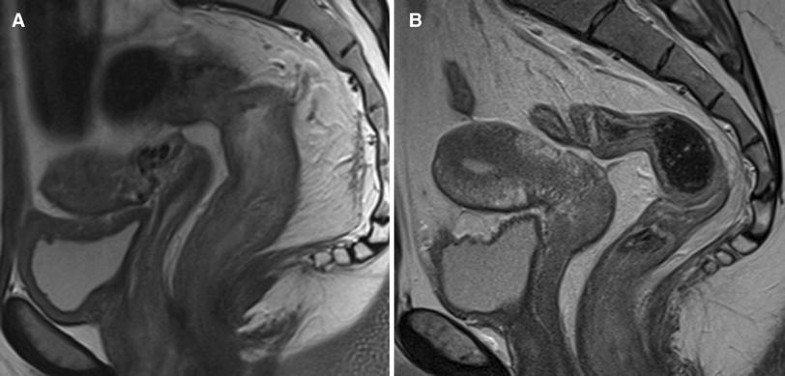MRI characteristics of proctitis in Crohn’s disease on perianal MRI ...