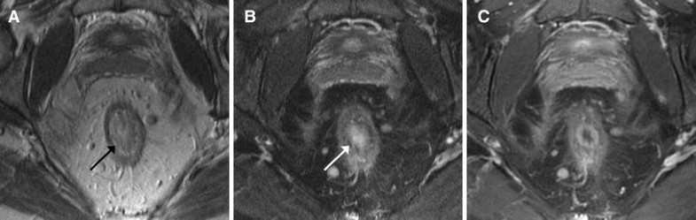MRI characteristics of proctitis in Crohn’s disease on perianal MRI ...