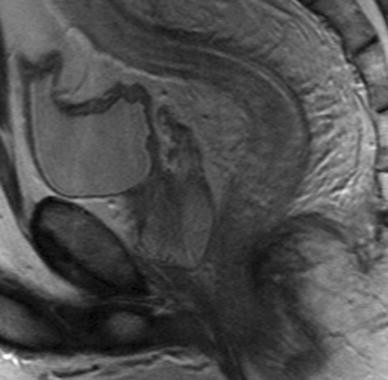MRI characteristics of proctitis in Crohn’s disease on perianal MRI ...