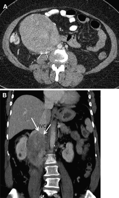 The embedded organ sign | SpringerLink