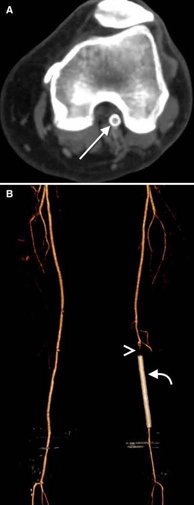 Role of lower extremity run-off CT angiography in the evaluation of ...