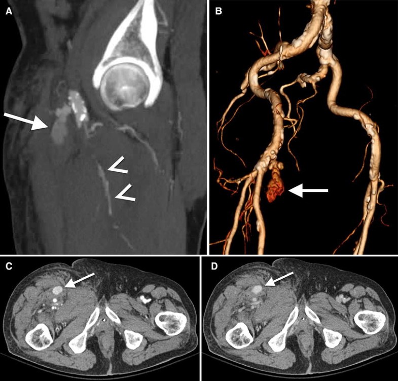 Role of lower extremity run-off CT angiography in the evaluation of ...