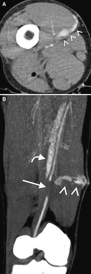 Role of lower extremity run-off CT angiography in the evaluation of ...