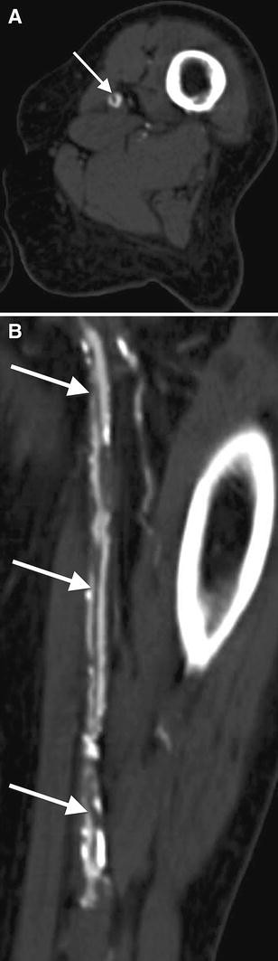 Role of lower extremity run-off CT angiography in the evaluation of ...