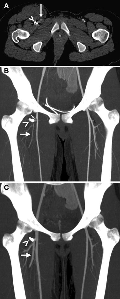 Role of lower extremity run-off CT angiography in the evaluation of ...