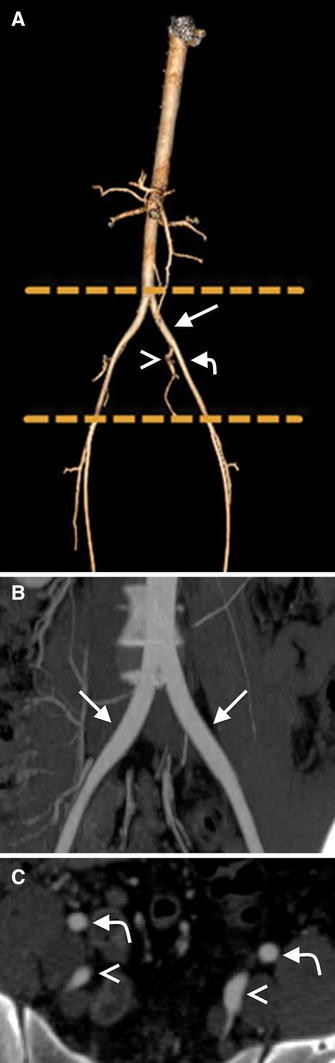 Role of lower extremity run-off CT angiography in the evaluation of ...