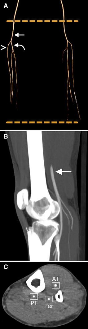 Role of lower extremity run-off CT angiography in the evaluation of ...