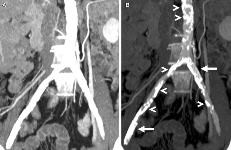 Role of lower extremity run-off CT angiography in the evaluation of ...