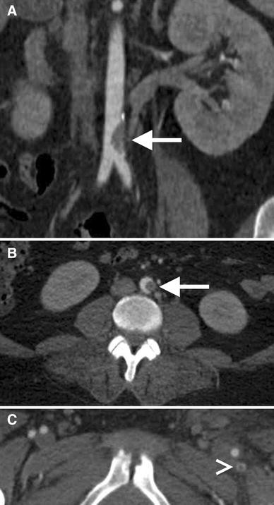 Role of lower extremity run-off CT angiography in the evaluation of ...