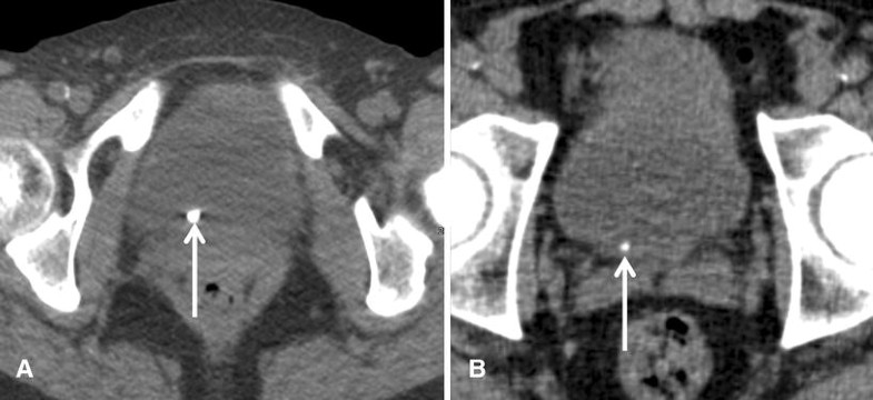 Comparison of prone vs. supine unenhanced CT imaging in patients with ...