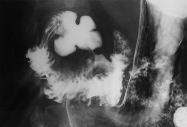 Cloverleaf duodenum | SpringerLink