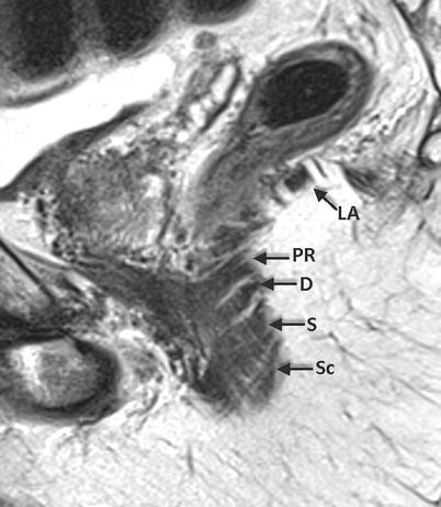 MRI of anal canal: normal anatomy, imaging protocol, and perianal ...