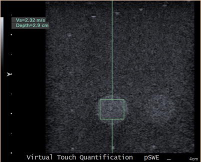 Principles of ultrasound elastography | SpringerLink