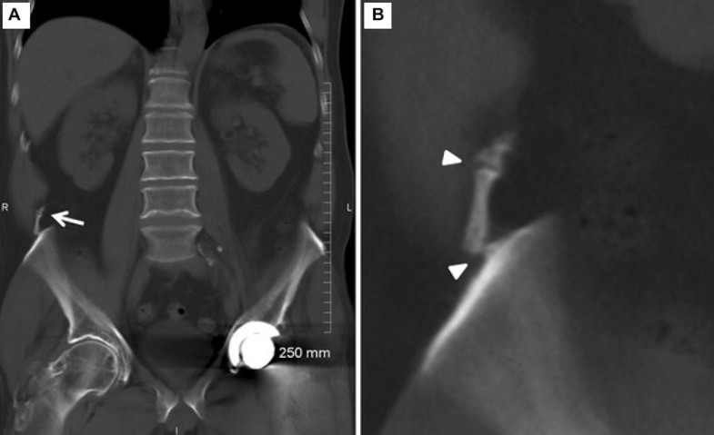 The “pelvic digit” | SpringerLink