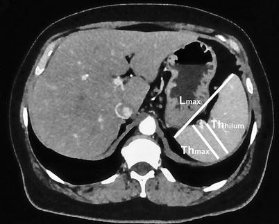 Spleen enlargement assessment using computed tomography: which ...