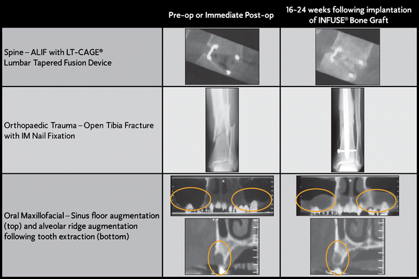 A comprehensive clinical review of recombinant human bone morphogenetic ...