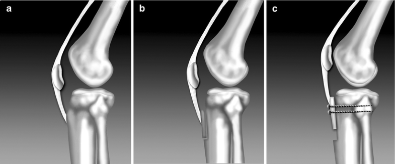 Tibial tubercle osteotomy in patello-femoral instability and in ...