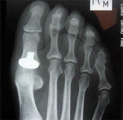 First metatarsophalangeal hemiarthroplasty for hallux rigidus ...