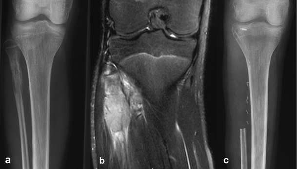 Proximal fibula resection in the treatment of bone tumours | SpringerLink