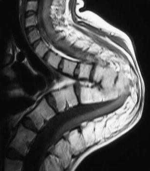 Kyphotic deformity in spinal tuberculosis and its management | SpringerLink