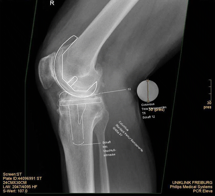 Digital templating in total knee and hip replacement: an analysis of ...