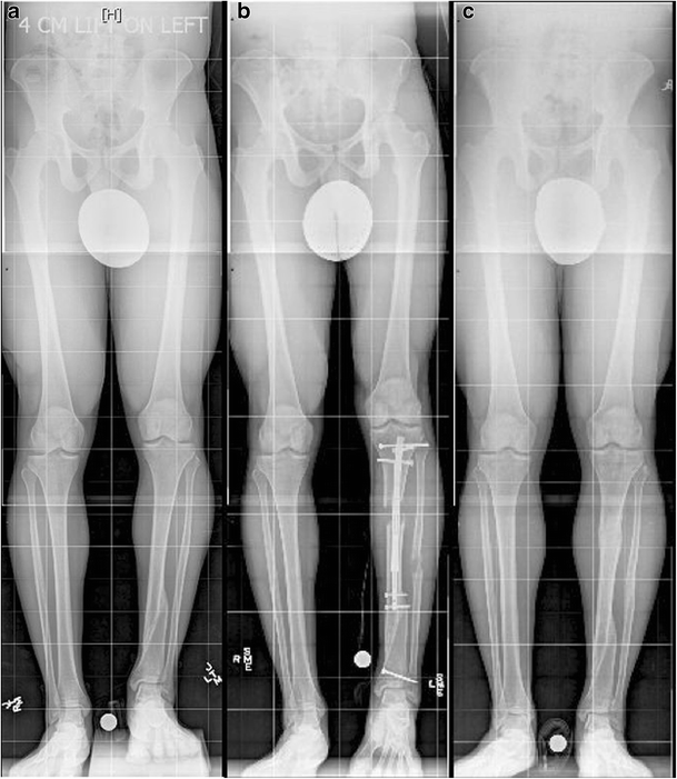 Use of internal lengthening nails in post-traumatic sequelae | SpringerLink