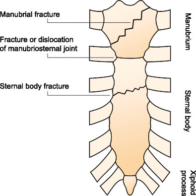 Current treatment and outcomes of traumatic sternal fractures—a ...