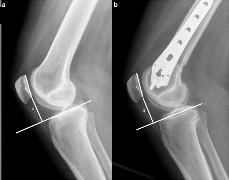 Distal femoral varus osteotomy: results of the lateral open-wedge ...