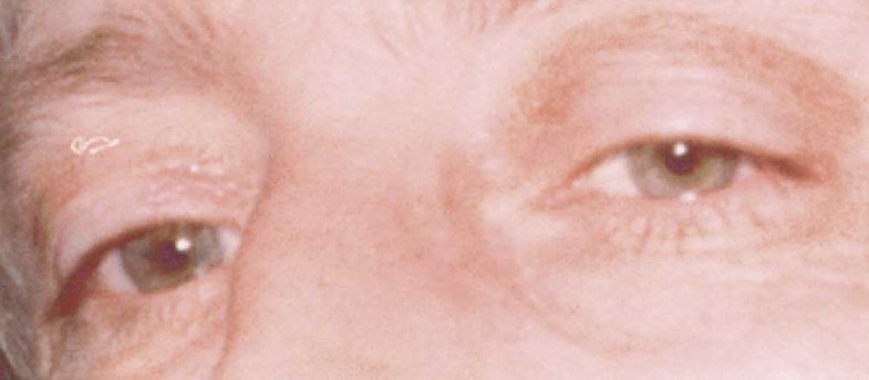 Ptosis: Causes, Presentation, and Management | SpringerLink