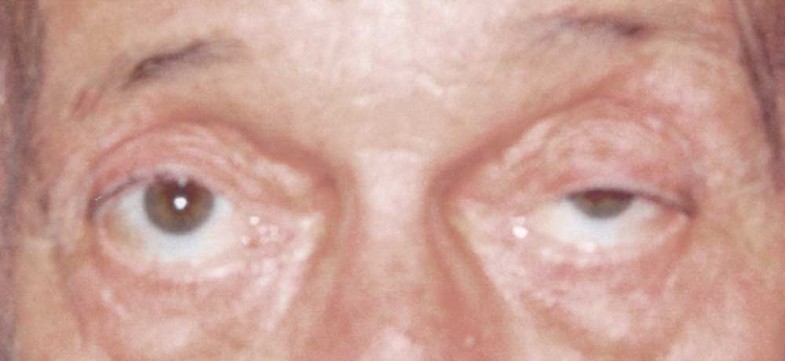 Ptosis: Causes, Presentation, and Management | SpringerLink