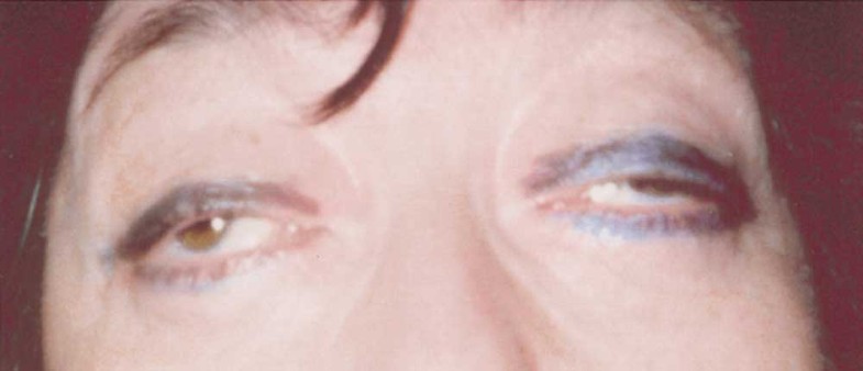 Ptosis: Causes, Presentation, and Management | SpringerLink