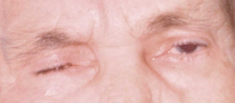 Ptosis: Causes, Presentation, and Management | SpringerLink