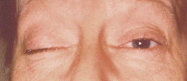 Ptosis: Causes, Presentation, and Management | SpringerLink