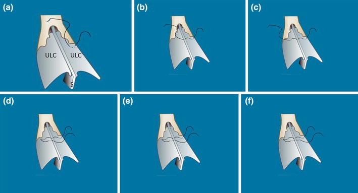 The Role of Upper Lateral Cartilage in Dorsal Reconstruction After Hump ...