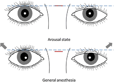 Frontalis Muscle Flap Advancement for Correction of Severe Ptosis Under ...