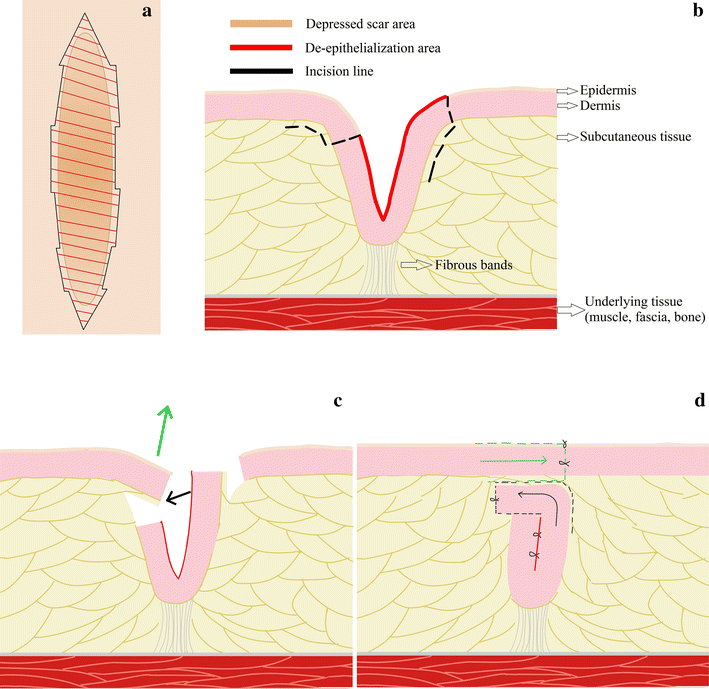 A New Technique for Correction of Tethered and Depressed Scars: Layered ...
