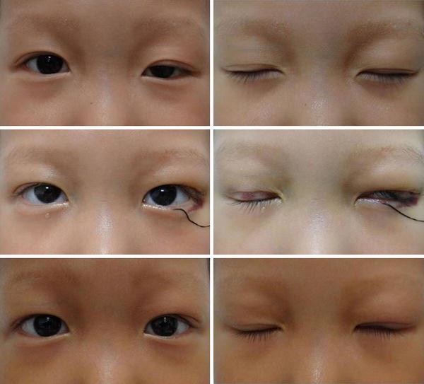 A Modified Levator Resection Technique Involving Retention of the ...