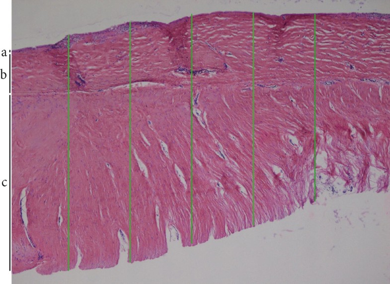 The Histological Composition of Capsular Contracture Focussed on the ...