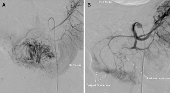 Transarterial Embolization and Doxorubicin Eluting Beads-Transarterial ...